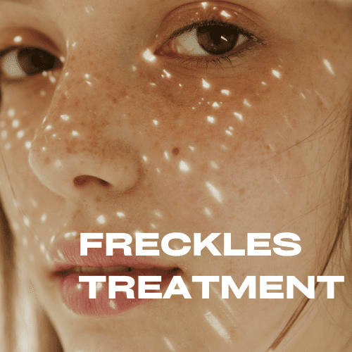 Say Goodbye to Freckles with Advanced Skin Treatments - Ashwini Clinic