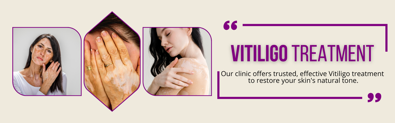 Vitiligo - Ashwini Clinic