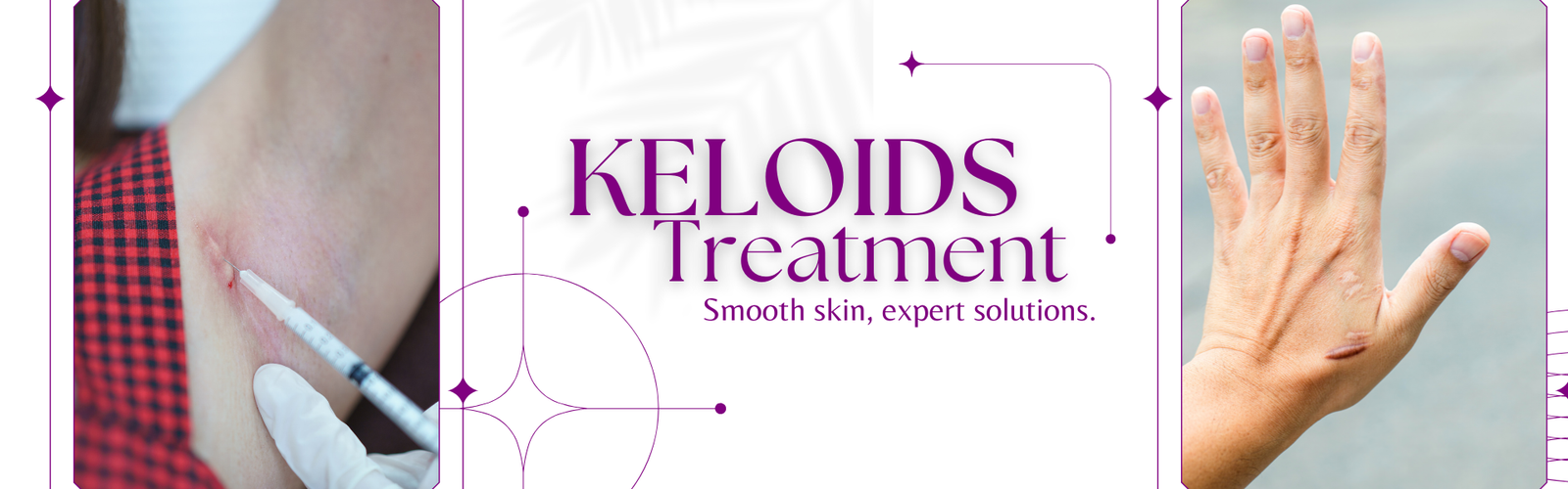 Keloids - Ashwini Clinic
