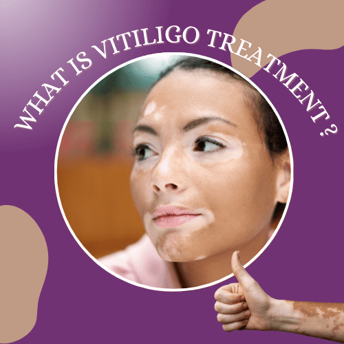 Vitiligo Treatment and Effective Management – A Complete Guide ...