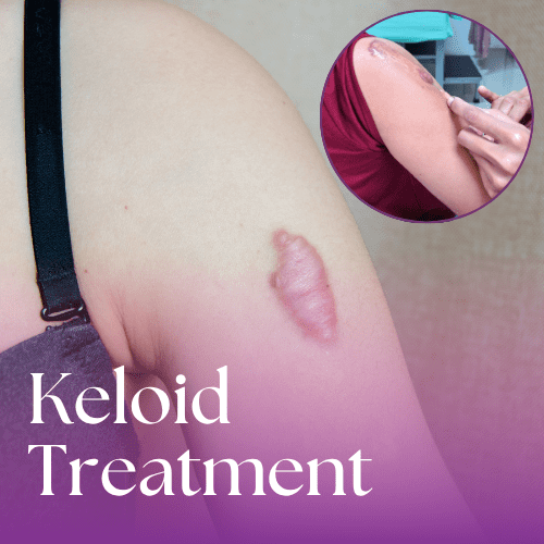 Keloids Treatment and Its Solutions – A Complete Guide to Smooth, Scar ...